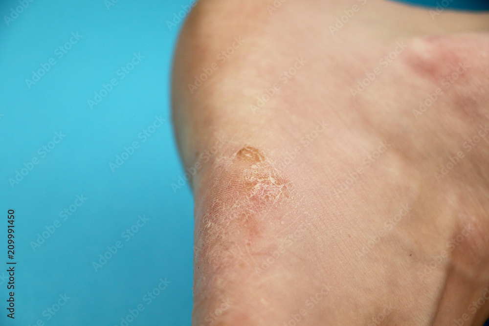 Fungus of foot close-up, isolated on blue background. The concept ...