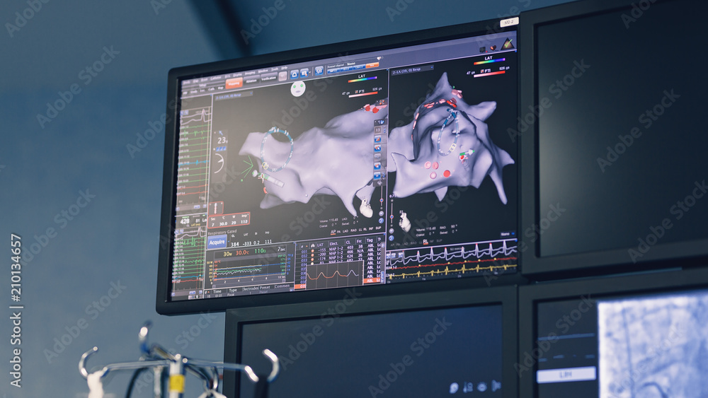 Electrophysiology study looks at the conduction or electrical system of ...