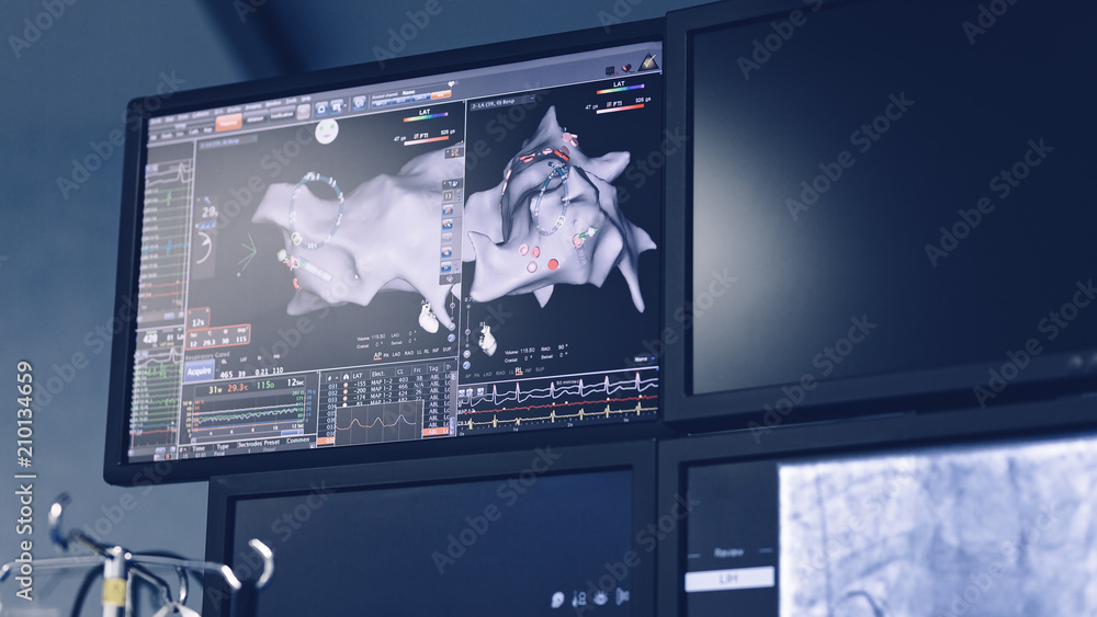 Heart electroanatomic map using new technologies focusing on new ...