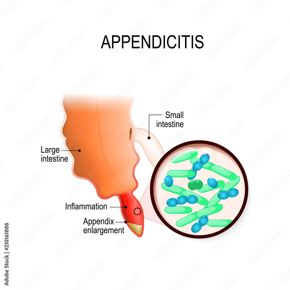 Appendicitis. Human appendix and bacterial growth inside the appendix ...