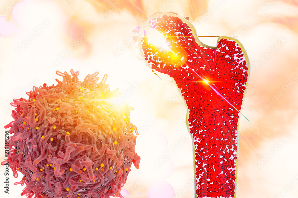 Bone research concept bone cancer and stem cells treatment Osteoporosis ...