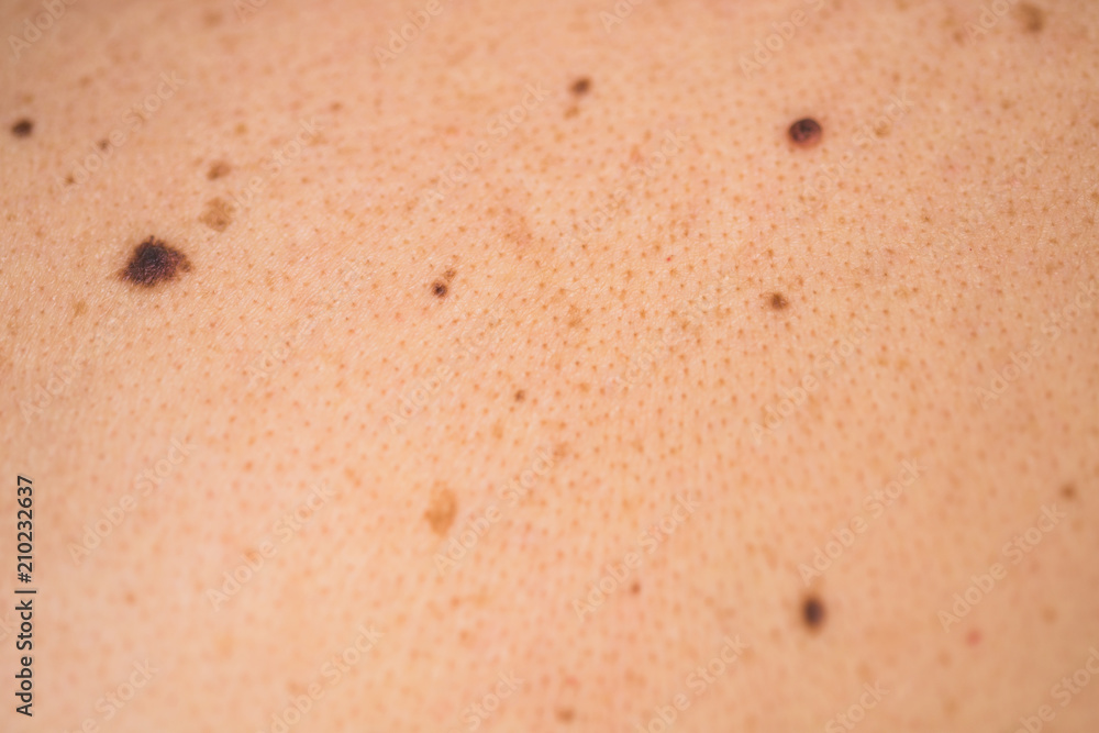 Detail of the bare skin on man in the back, Disorders of body with ...