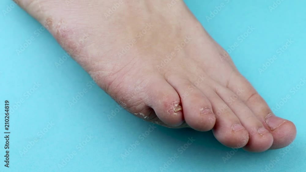 Fungus of foot close-up, isolated on blue background. The concept ...