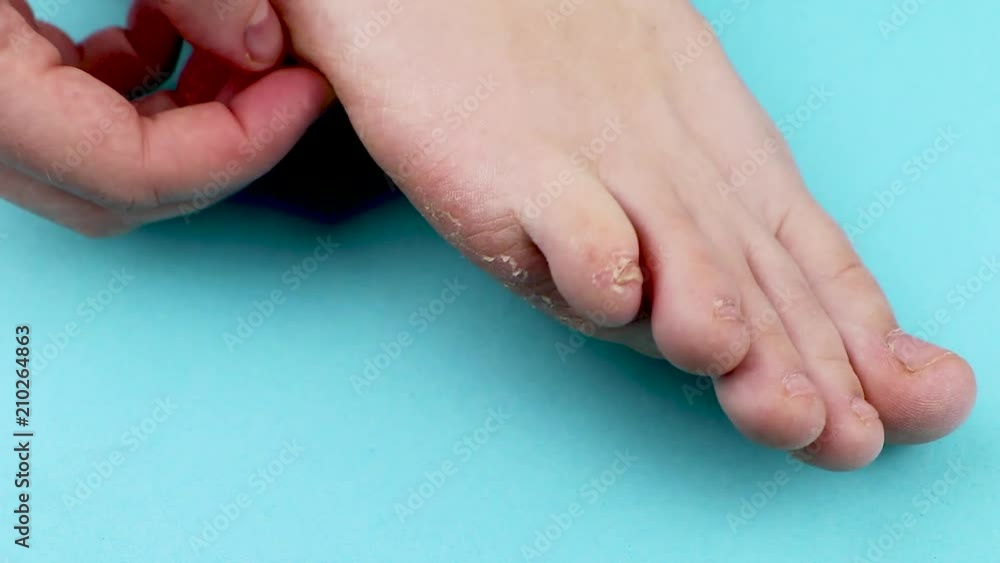Fungus of foot close-up, isolated on blue background. The concept ...