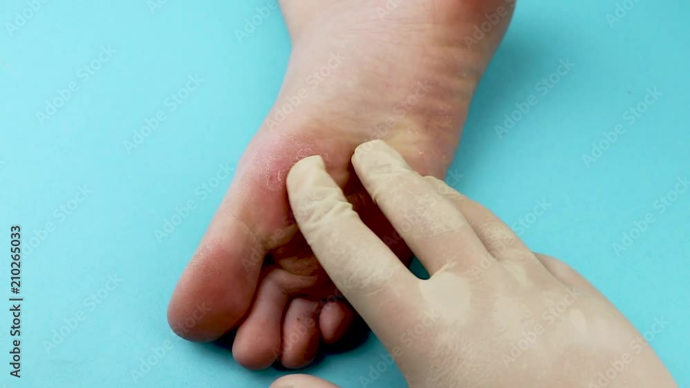 Video Stock Fungus of foot close-up, isolated on blue background. The ...