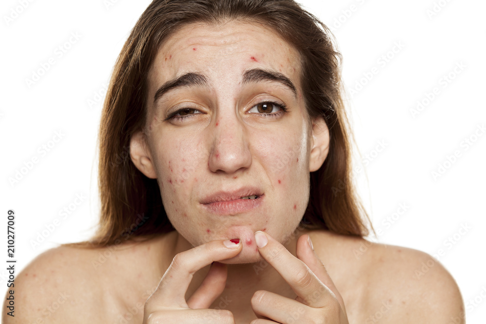young unhappy woman with problematic skin and without makeup squeeze ...