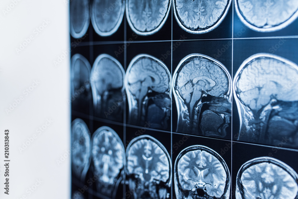 MRI of the head and brain of a person, tomography Stock Photo | Adobe Stock