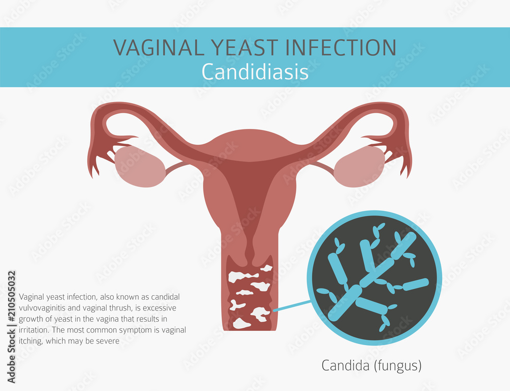 Vaginal yeast infection. Candidiasis. Ginecological medical desease ...