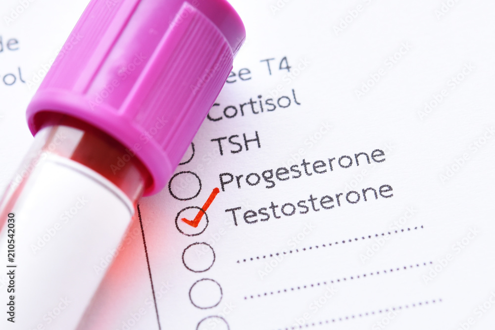 Blood sample with laboratory requisition form for testosterone hormone ...