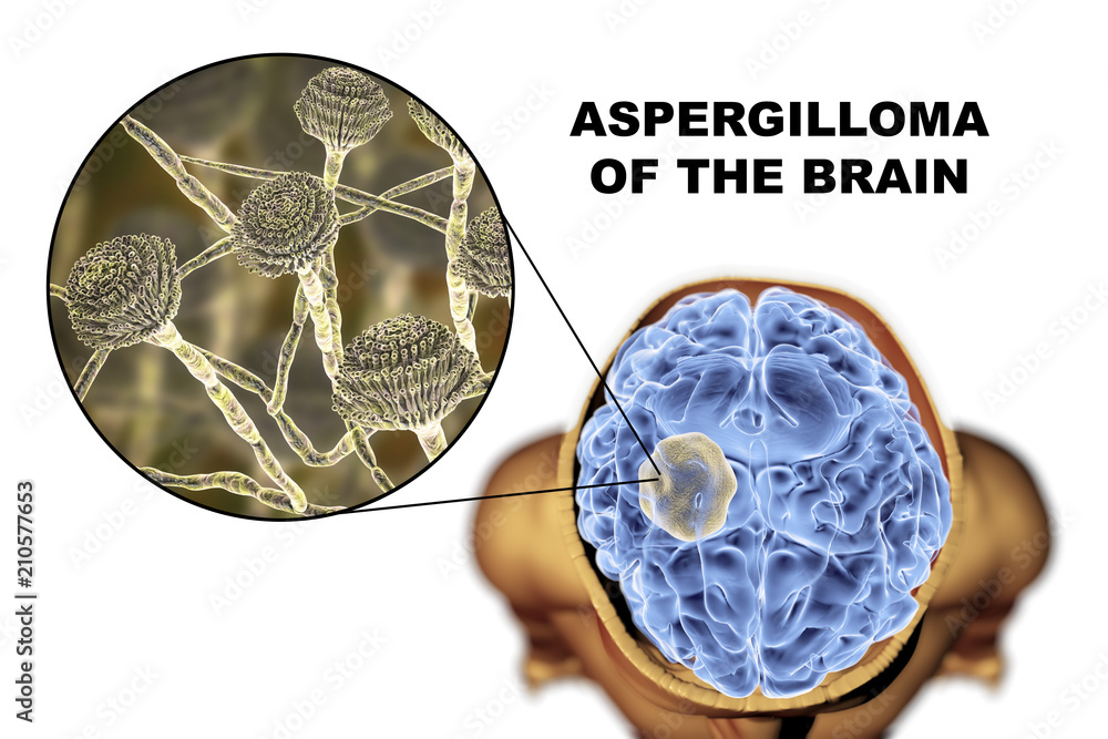 Aspergilloma of the brain and close-up view of fungi Aspergillus, 3D ...