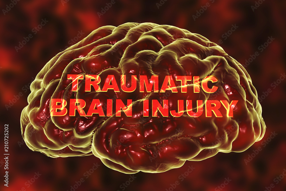 Traumatic injury of human brain, 3D illustration. Conceptual image ...
