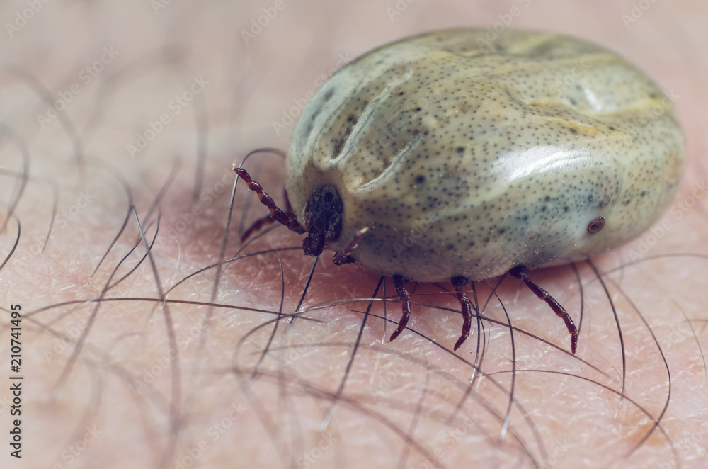 Tick filled with blood sitting on human skin Stock Photo | Adobe Stock