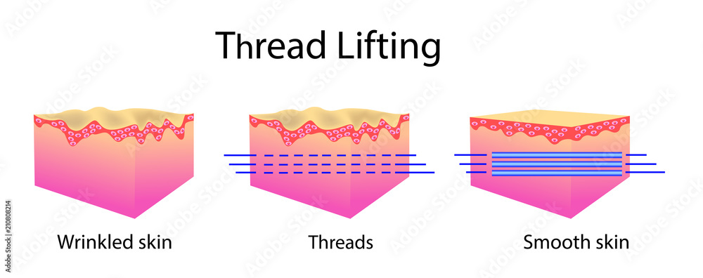 Thread lifting, vector illustration and skin cells, before after effect ...