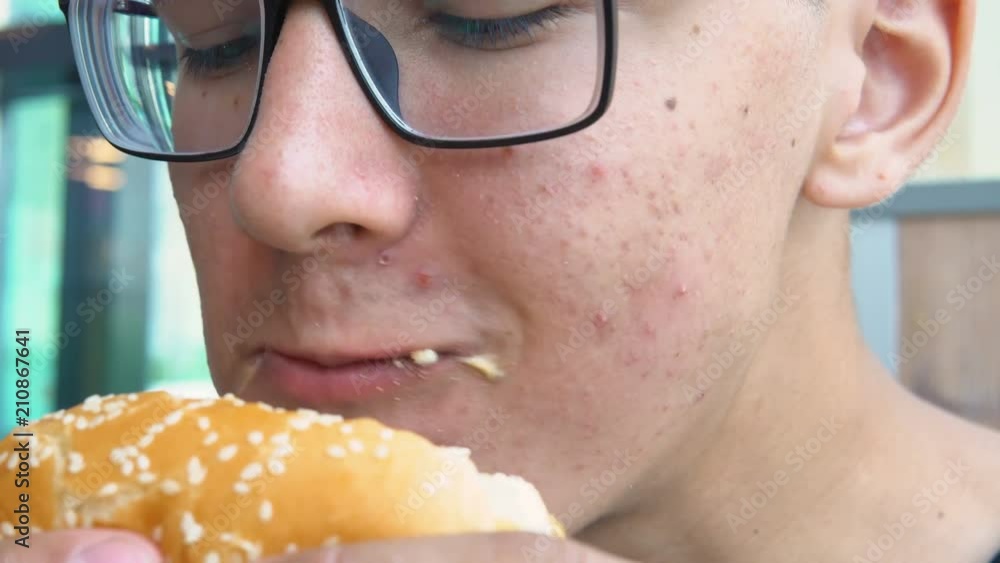 A young man with acne on his face eats hamburger in a fast food ...