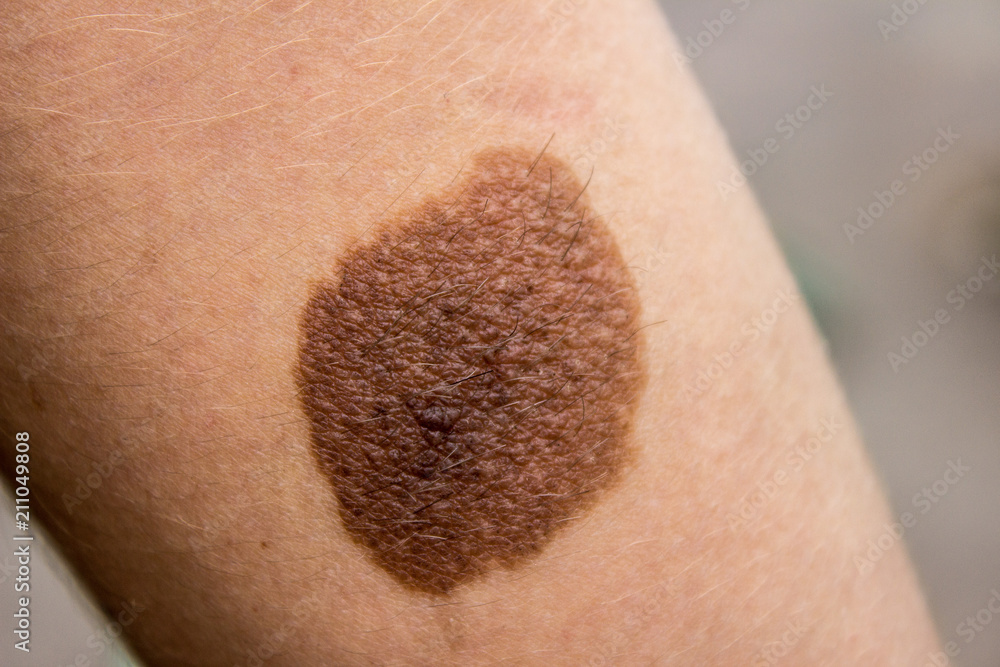 large mole on the skin Stock Photo | Adobe Stock