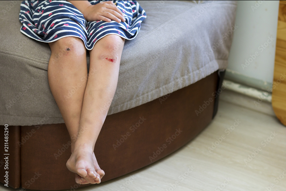 Close-up of young child girl barefooted legs with bruised damaged ...