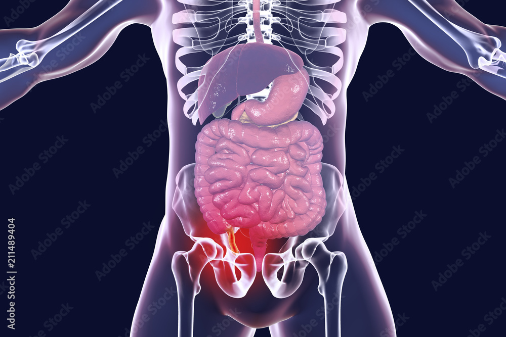 Acute appendicitis, 3D illustration showing inflammed appendix on the ...