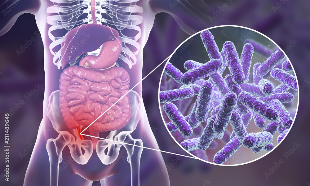 Acute appendicitis caused by bacteria of Enterobacteriaceae family, one ...
