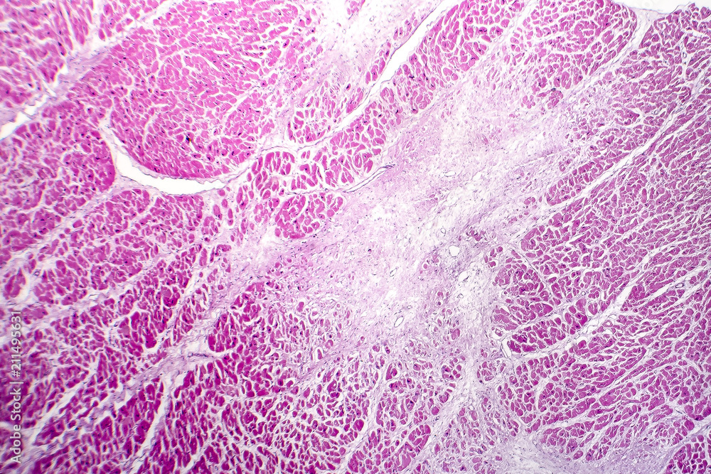Acute myocardial infarction, histology of heart tissue, light ...