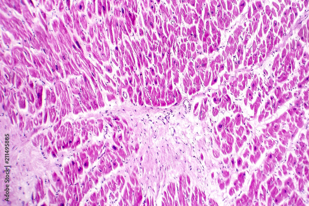 Photo & Art Print Acute myocardial infarction, histology of heart ...