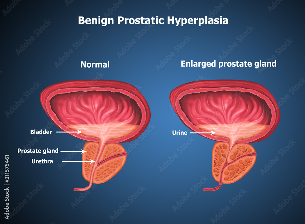 benign-prostatic-hyperplasia Stock Illustration | Adobe Stock