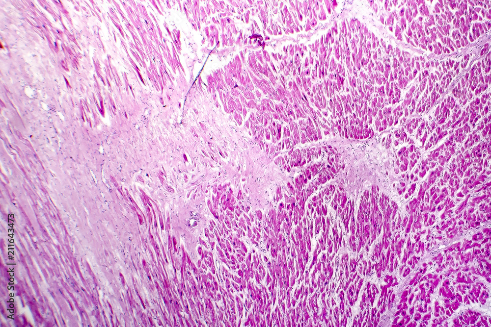 Acute myocardial infarction, histology of heart tissue, light ...
