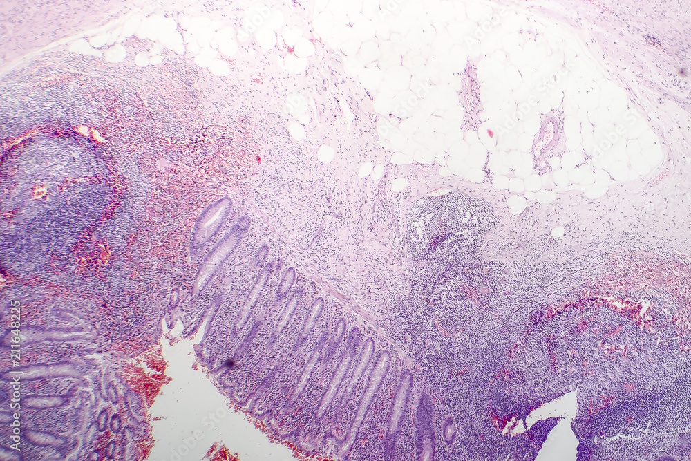 Histopathology of chronic appendicitis, light micrograph, photo under ...