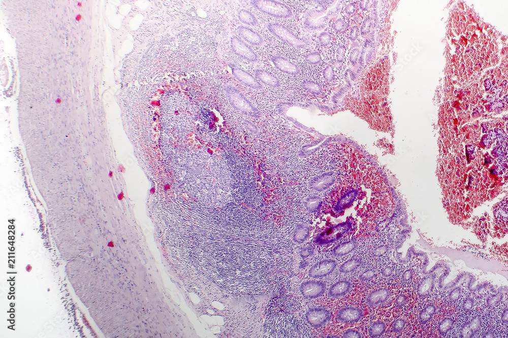 Histopathology of chronic appendicitis, light micrograph, photo under ...