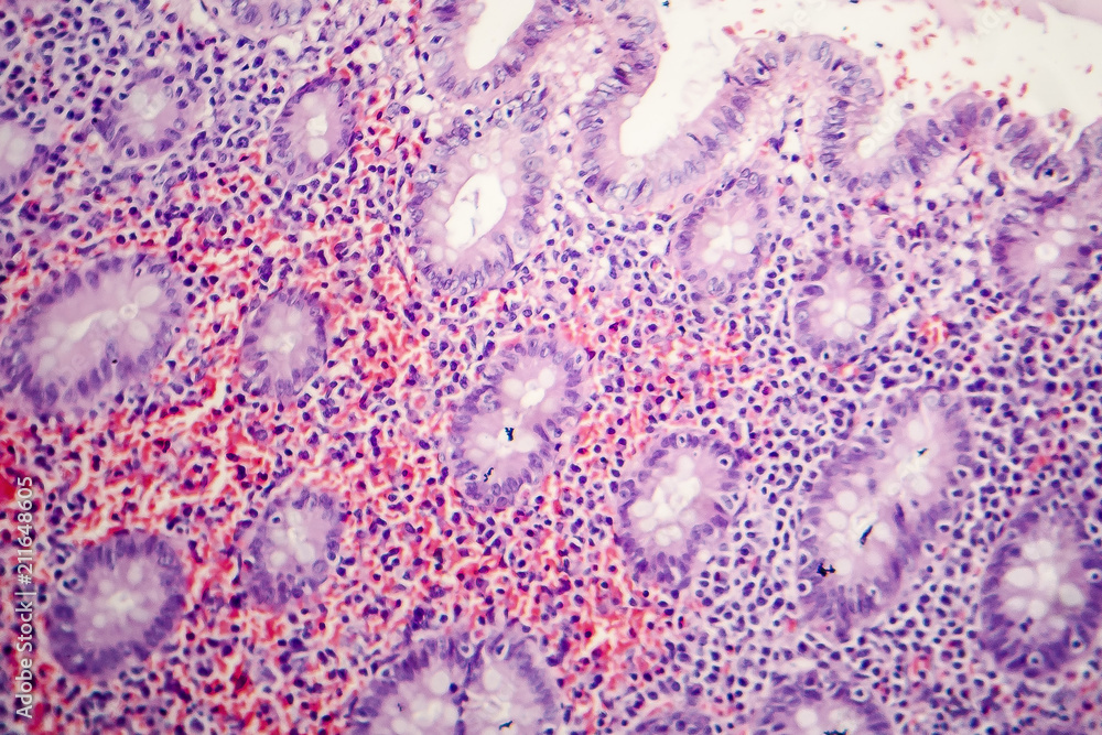 Histopathology of chronic appendicitis, light micrograph, photo under ...