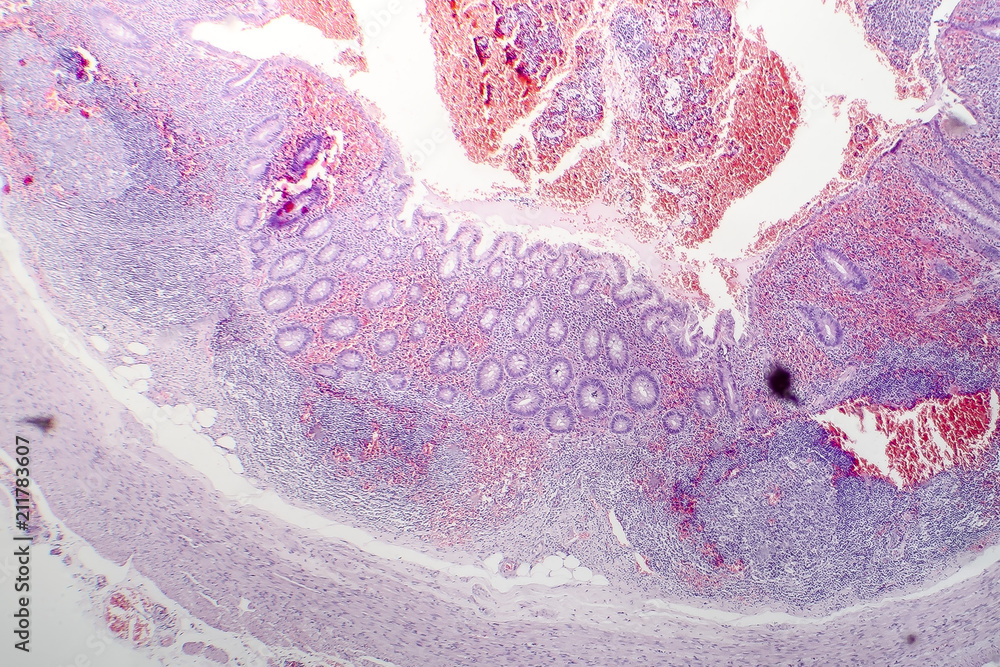 Histopathology of chronic appendicitis, light micrograph, photo under ...