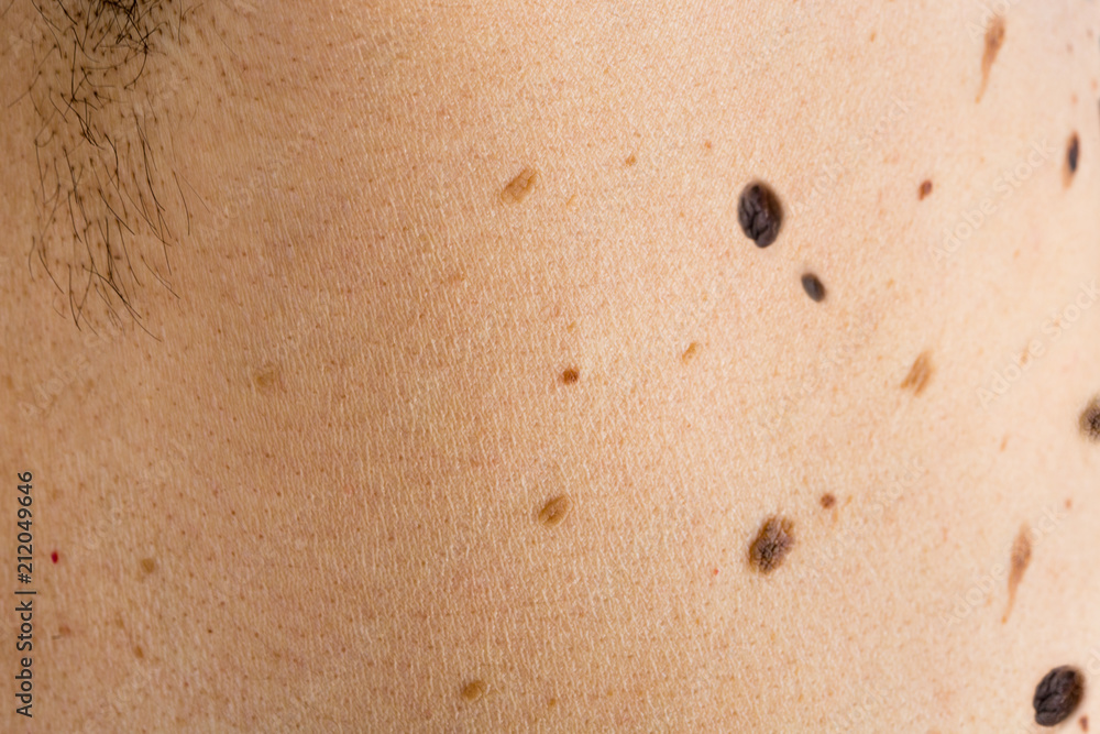 Detail of the bare skin on man in the back, Disorders of body with ...