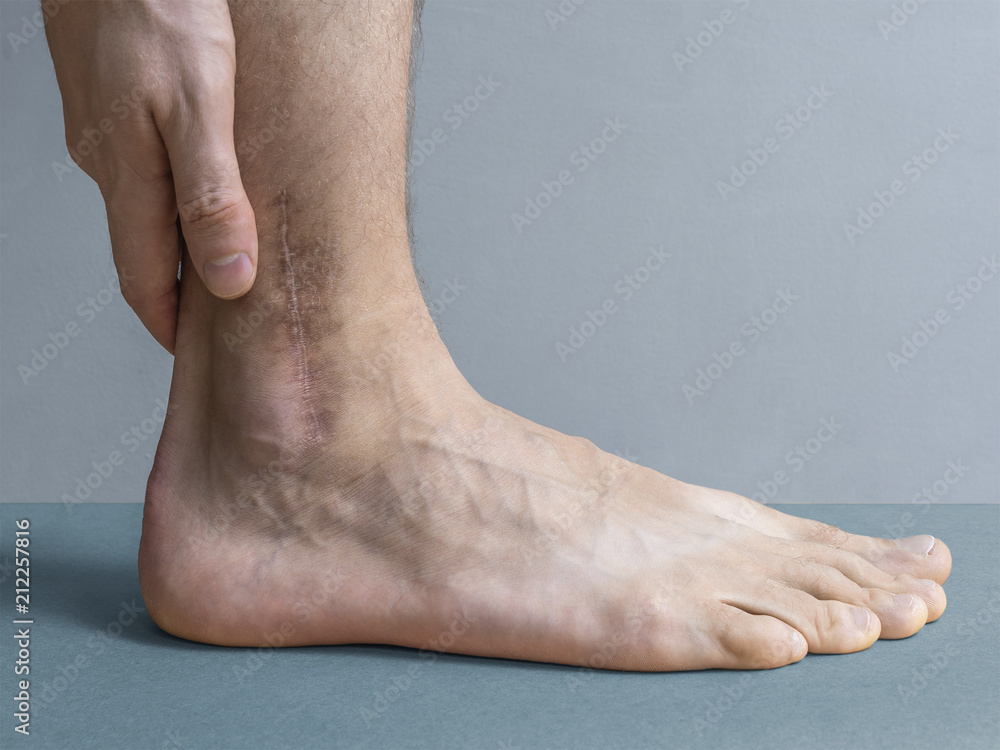 Foto de Old ankle scar man broken leg damaged in motorcycle accident do ...