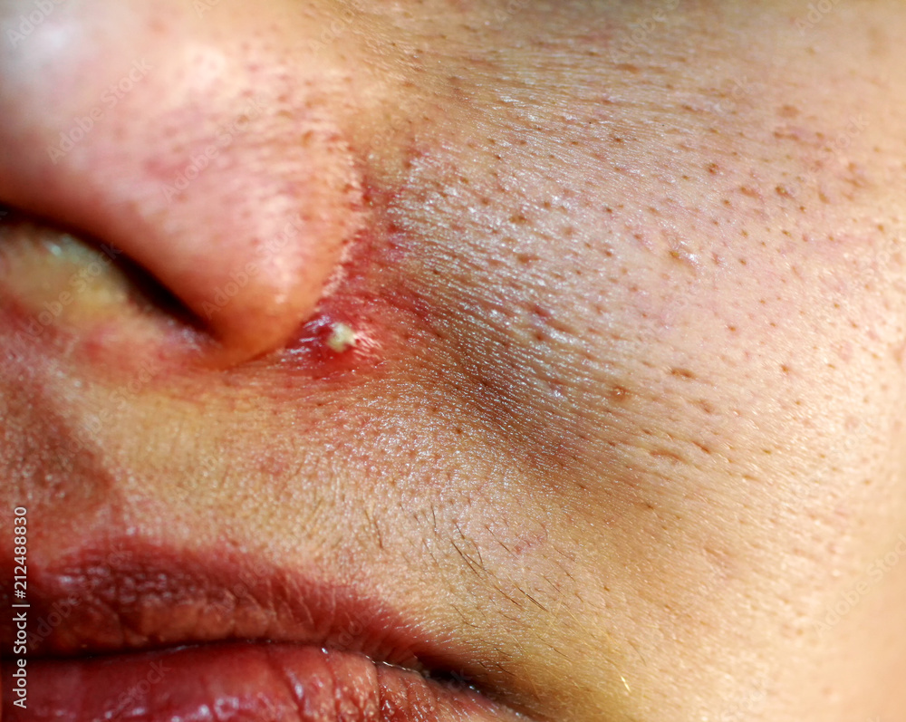 Inflamed skin of the face. Acne. Pimple purulent on the nose. Stock ...