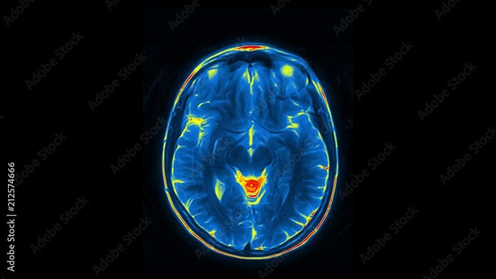 Computed medical tomography MRI upscaled scan of healthy young female ...
