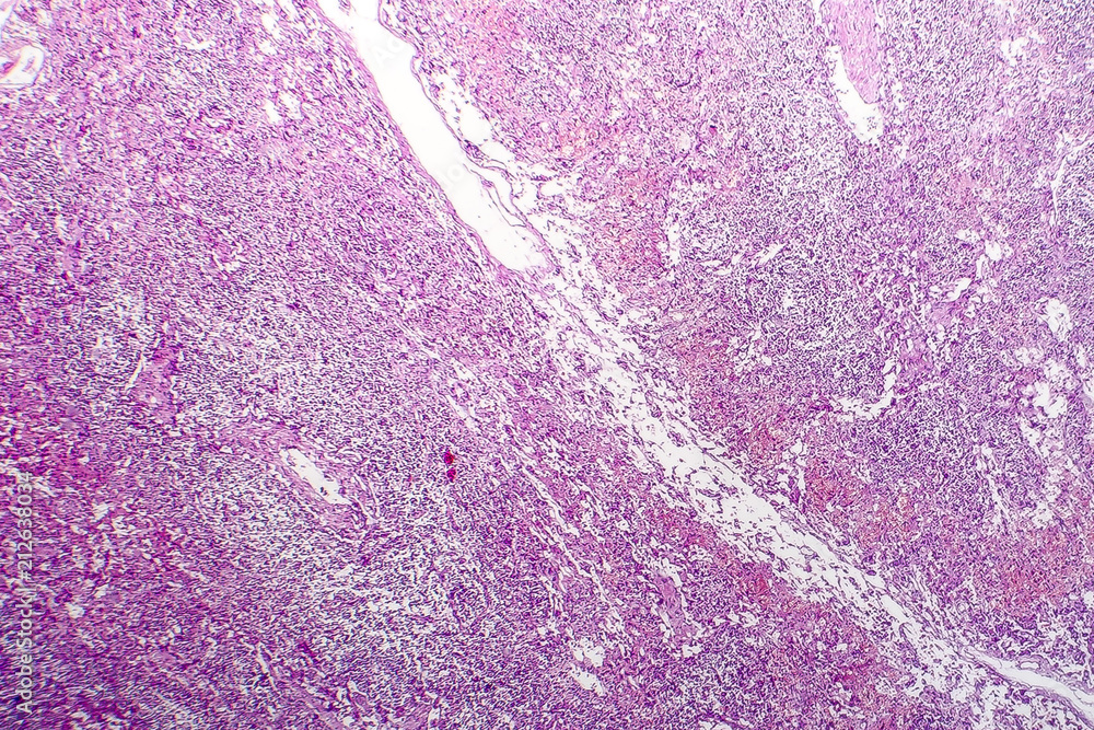 Hemorrhagic lymphadenitits, lymph node inflammation and hemorrhage ...