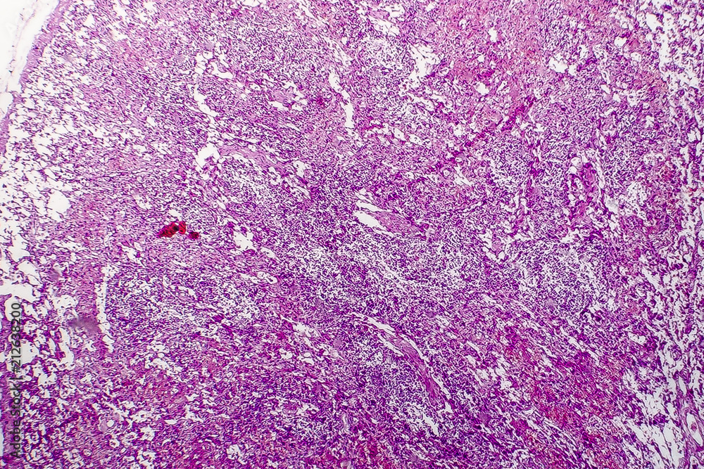 Hemorrhagic lymphadenitits, lymph node inflammation and hemorrhage ...