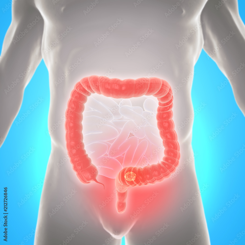 3d illustration of colorectal cancer in the human male Stock ...