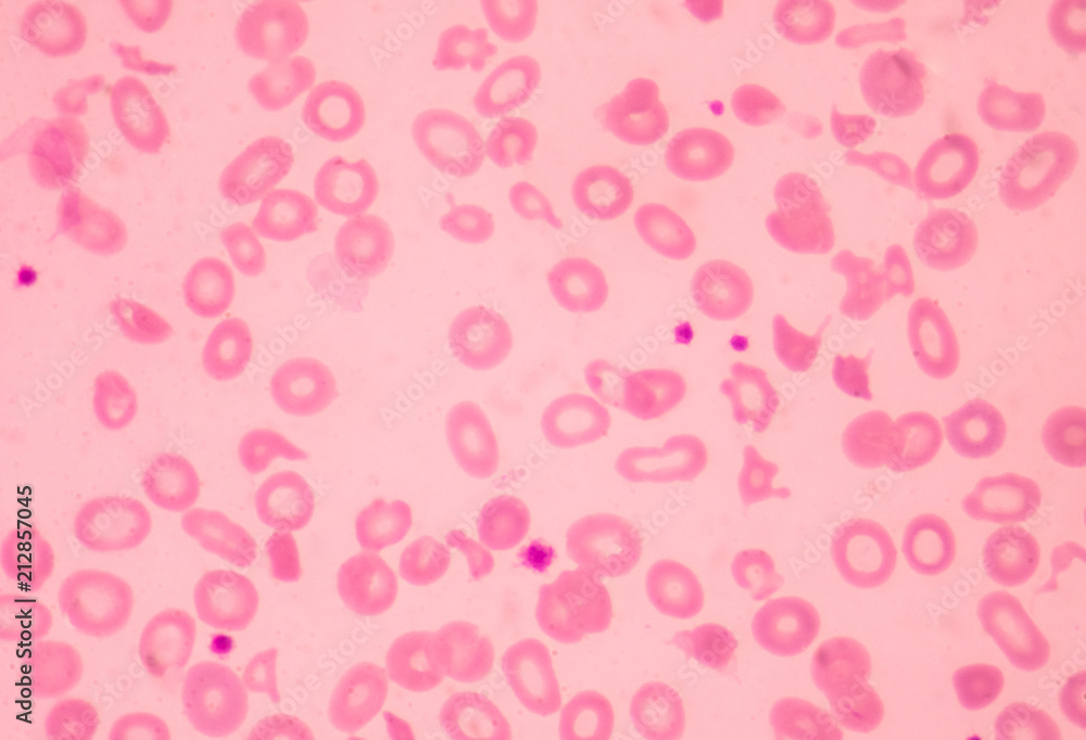 Thalassemia blood smear abnormal red blood cells morphology. #212857045 ...