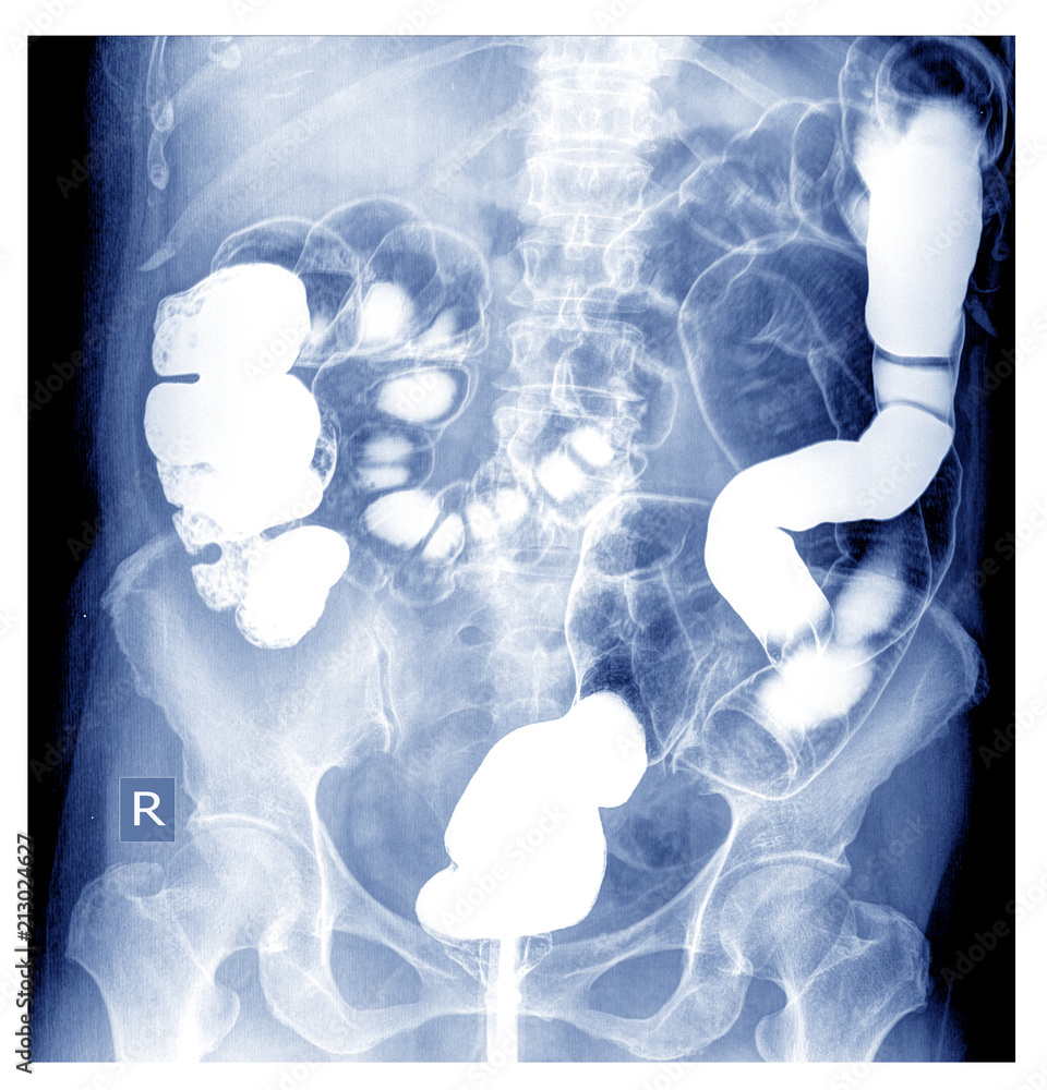 Special X-ray Barium Enema Congenital megacolon with transitional zone ...