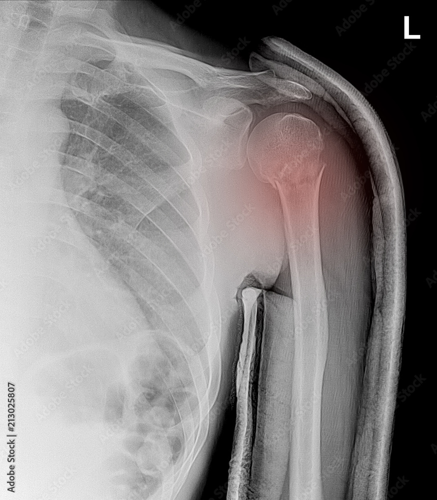 closed fracture left humerus under u-slab. Stock Photo | Adobe Stock