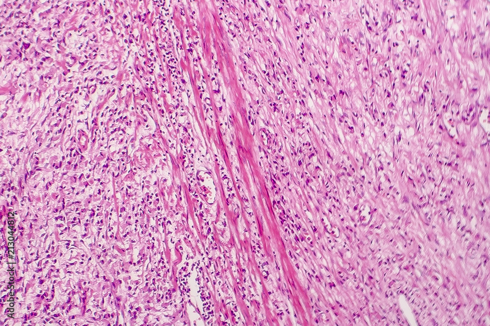 Signet ring cell carcinoma of the stomach, light micrograph, photo ...