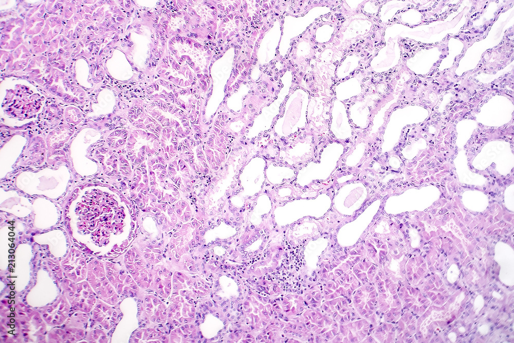 Cloudy swelling of the renal tubules in kidney, light micrograph, photo ...