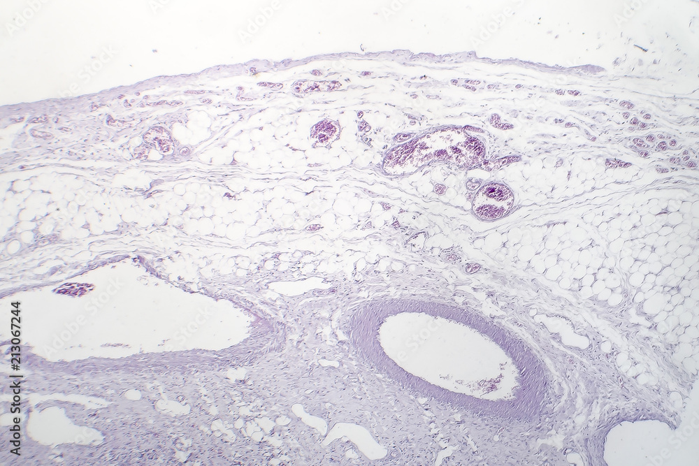 Granulomatous inflammation, light micrograph, photo under microscope ...