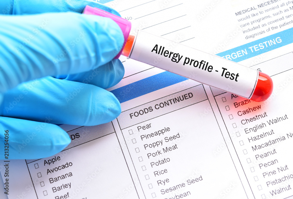 Blood sample tube with laboratory requisition form for allergy profile ...