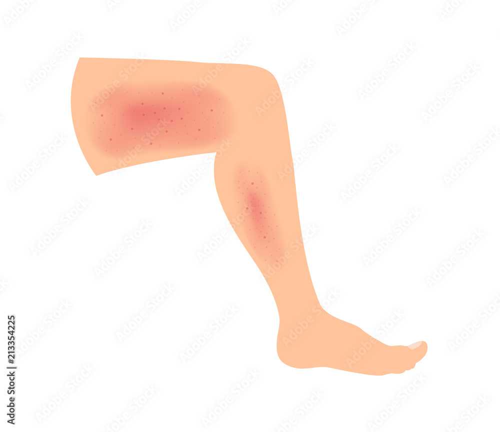 rash on leg skin vector Stock Vector | Adobe Stock