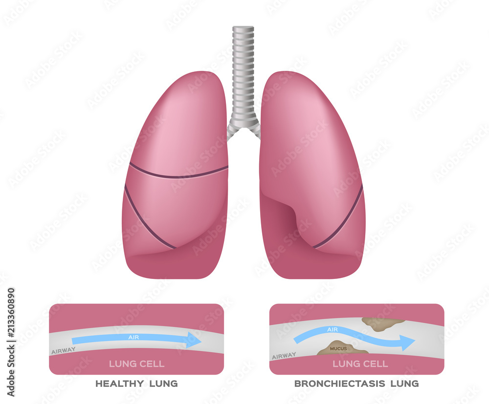 Bronchiectasis in lung vector infographic Stock Vector | Adobe Stock