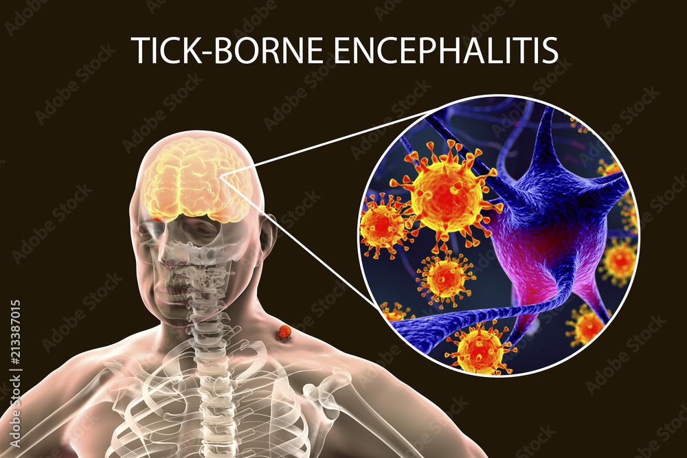 Tick-borne encephalitis concept, 3D illustration showing brain ...