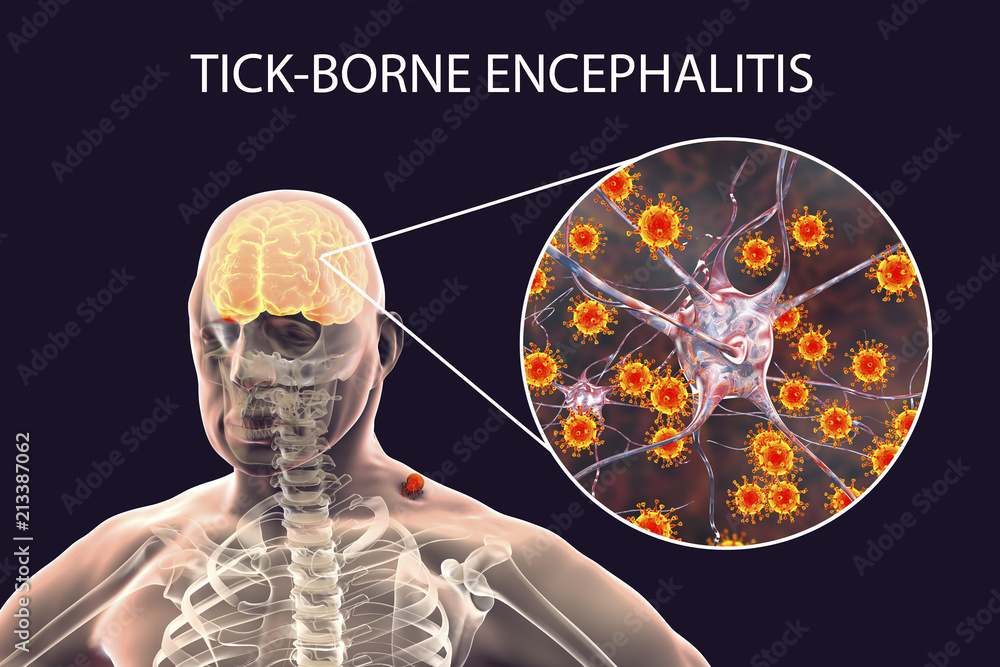 Tick-borne encephalitis concept, 3D illustration showing brain ...