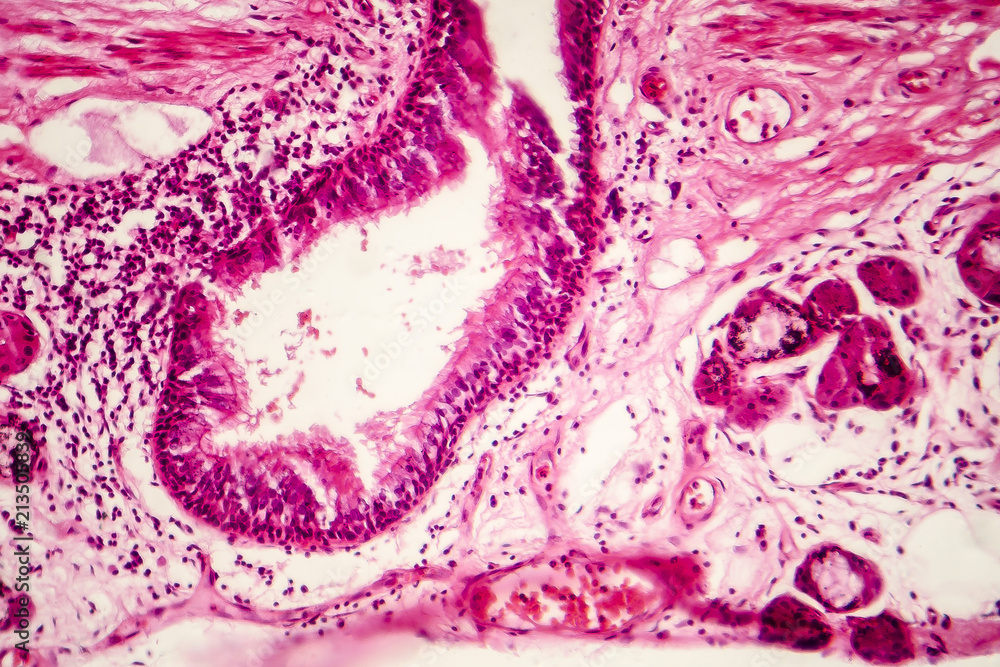 Squamous metaplasia of bronchial epithelium, light micrograph, photo ...