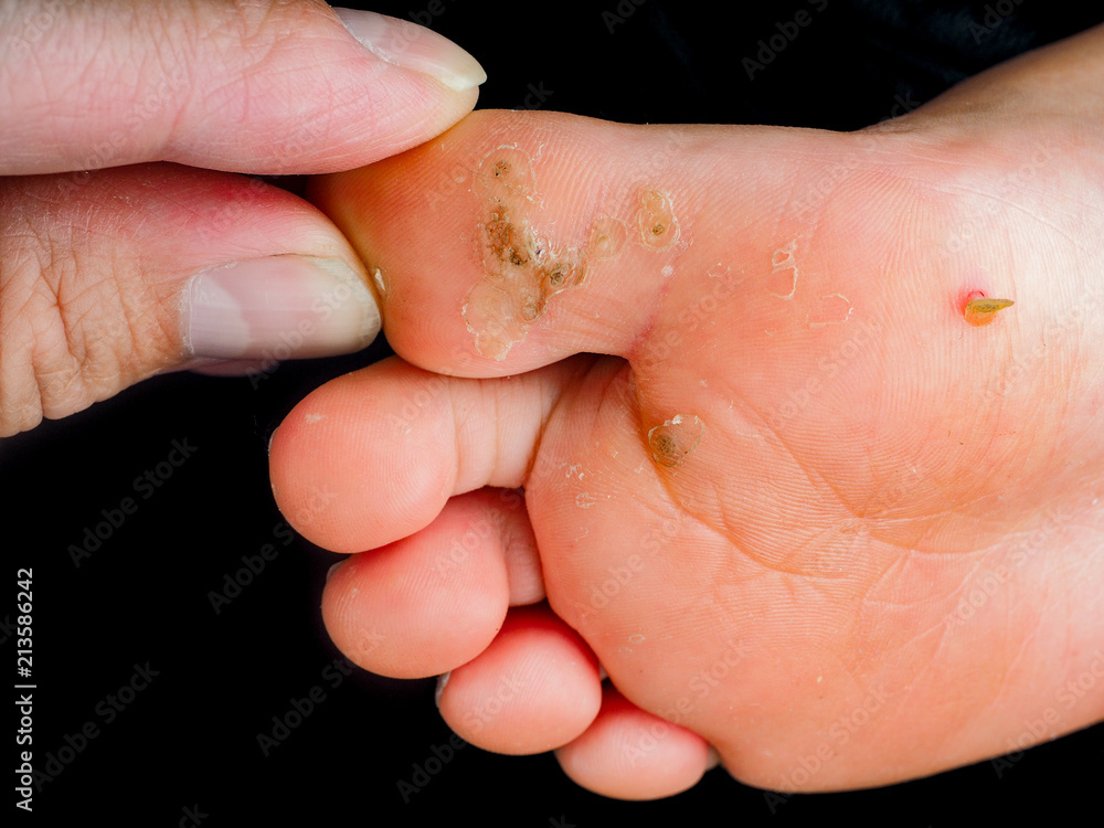 Child's foot sole, with verruca, wart, callus isolated towards black ...